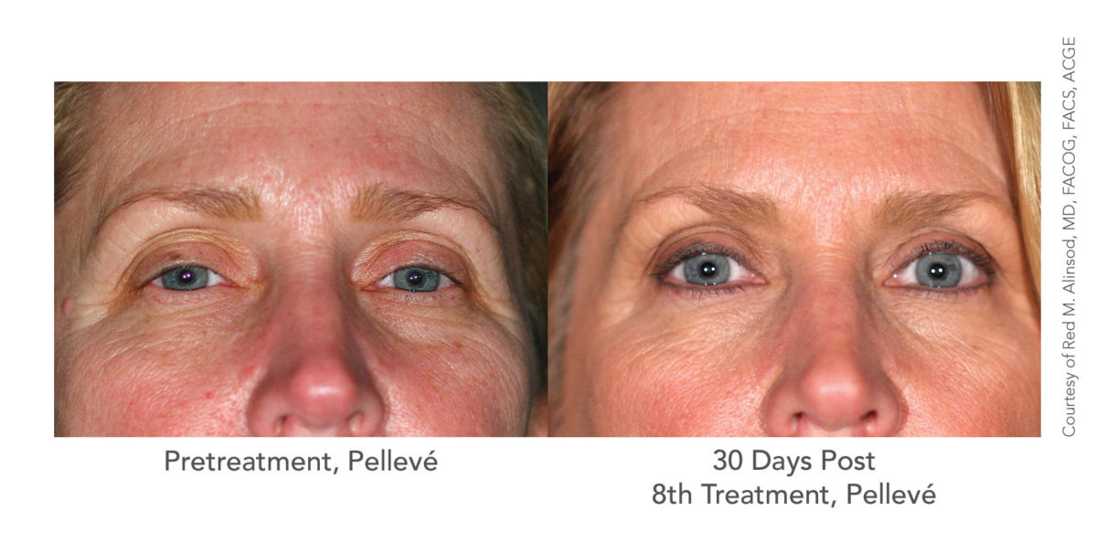 Pellevé Skin Tightening Wrinkle Reduction - Flagstaff, Arizona